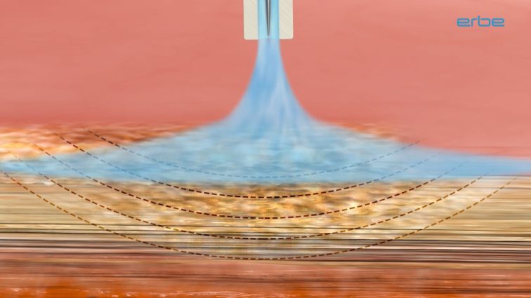 Argonplasma-Koagulation Archive - Medical Videos