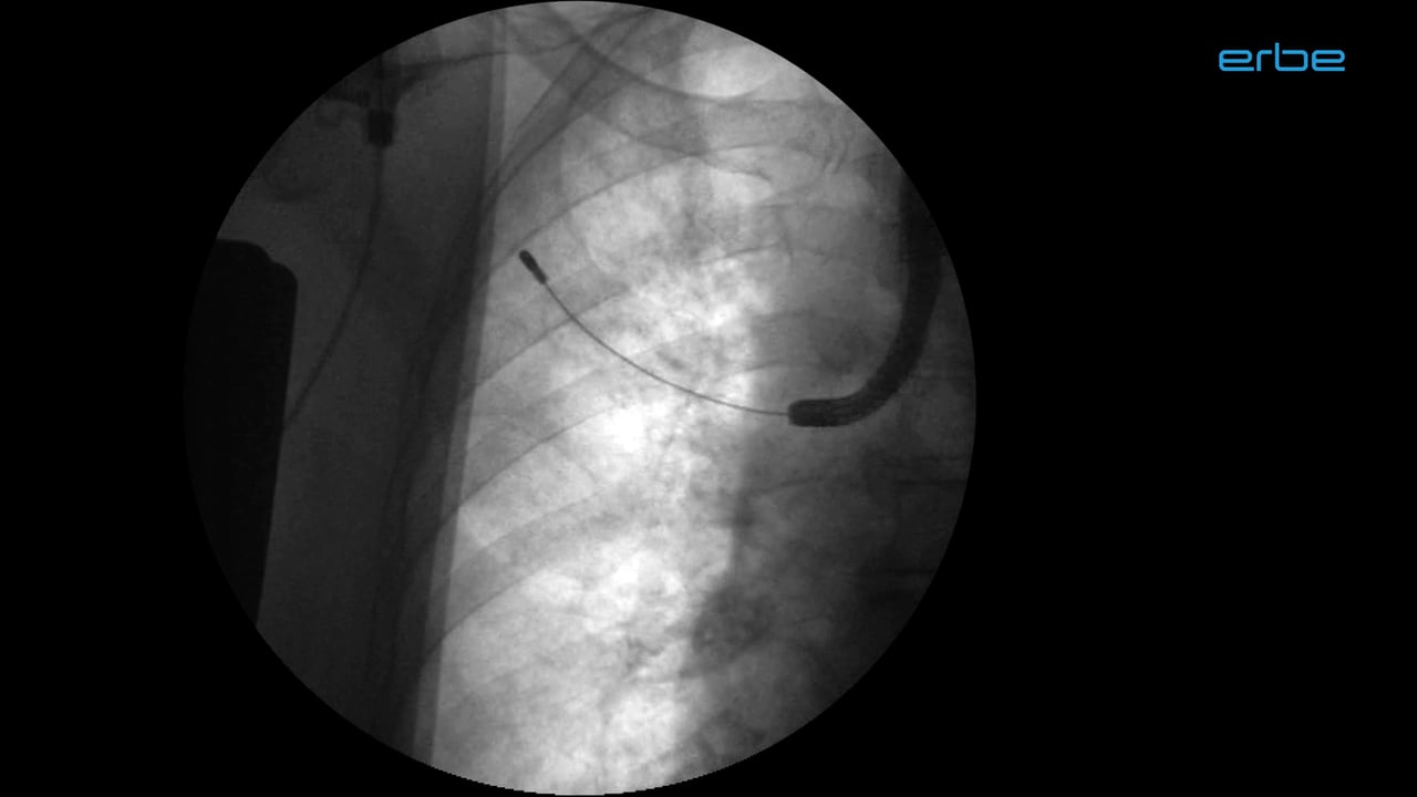 Bronchoskopie Archive - Medical Videos