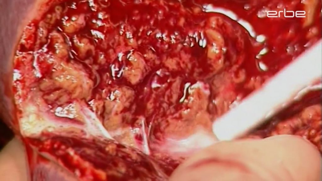 Surgery Archive - Page 2 of 3 - Medical Videos